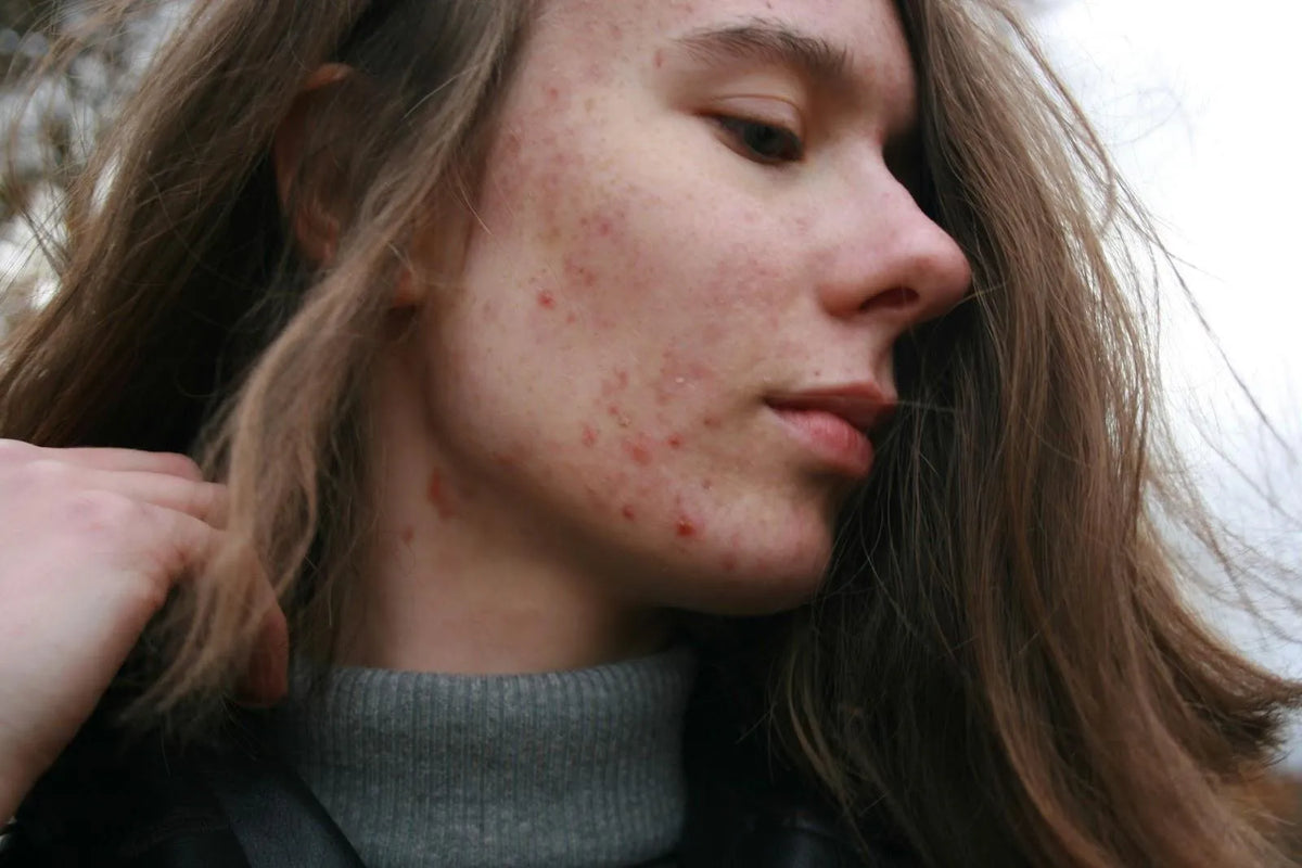 How SIBO Influences Acne & What You Can Do About It